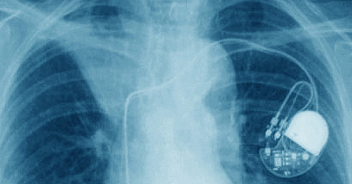 Medic din Iaşi, acuzat că a montat aproape 240 de stimulatoare cardiace ...