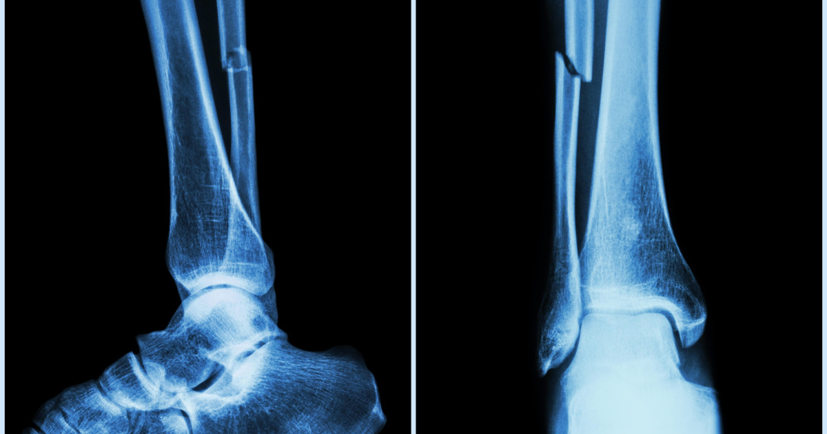 Fracturi vindecate în câteva minute: un lipici pentru oase, soluția ...