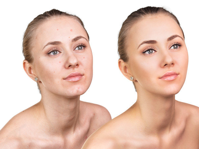 Acnee pe spate? Ce e de facut cand apare